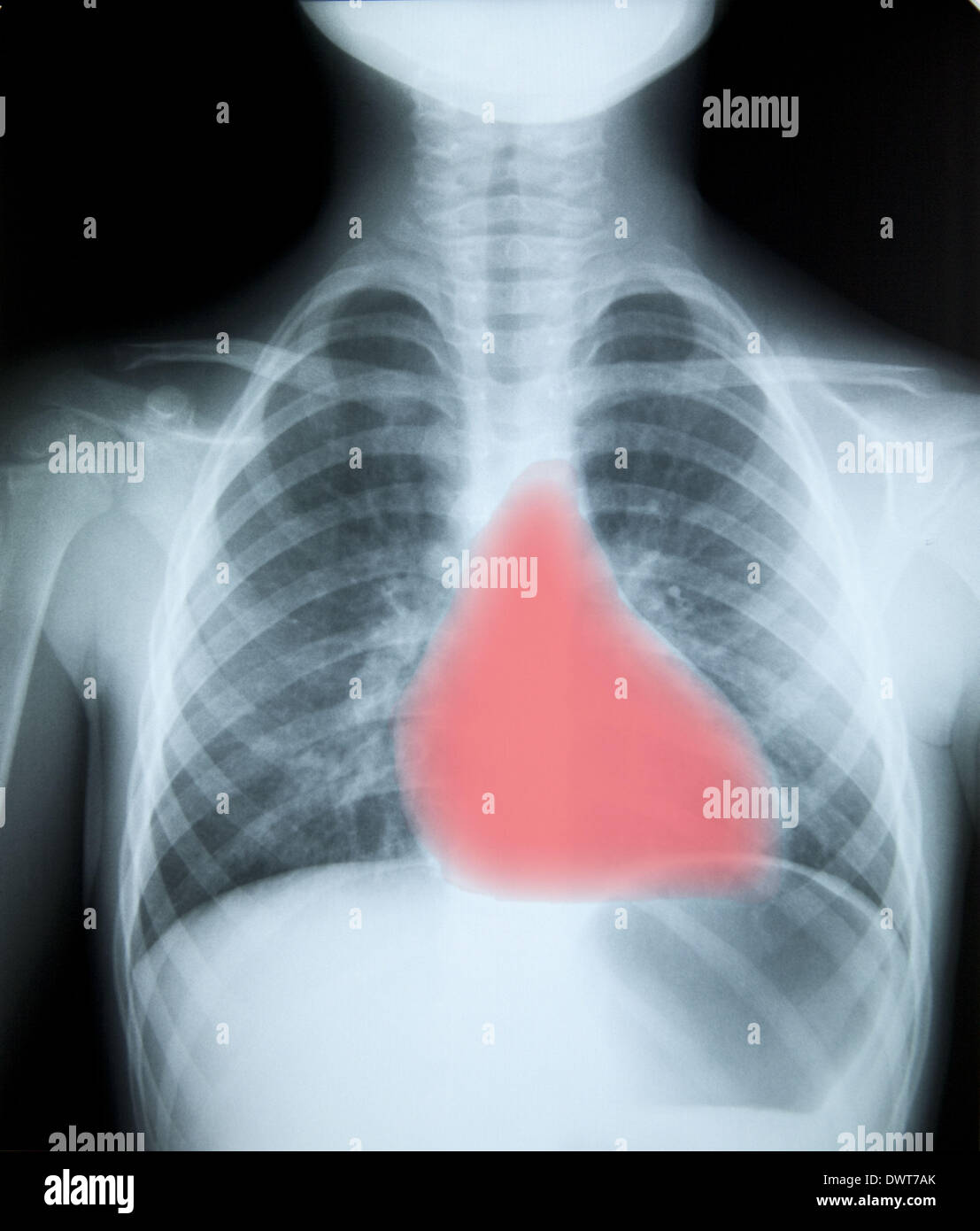 Thorax x ray Stock Photo - Alamy