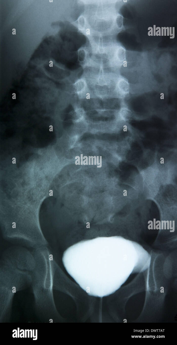 Retrograde cystography hi-res stock photography and images - Alamy