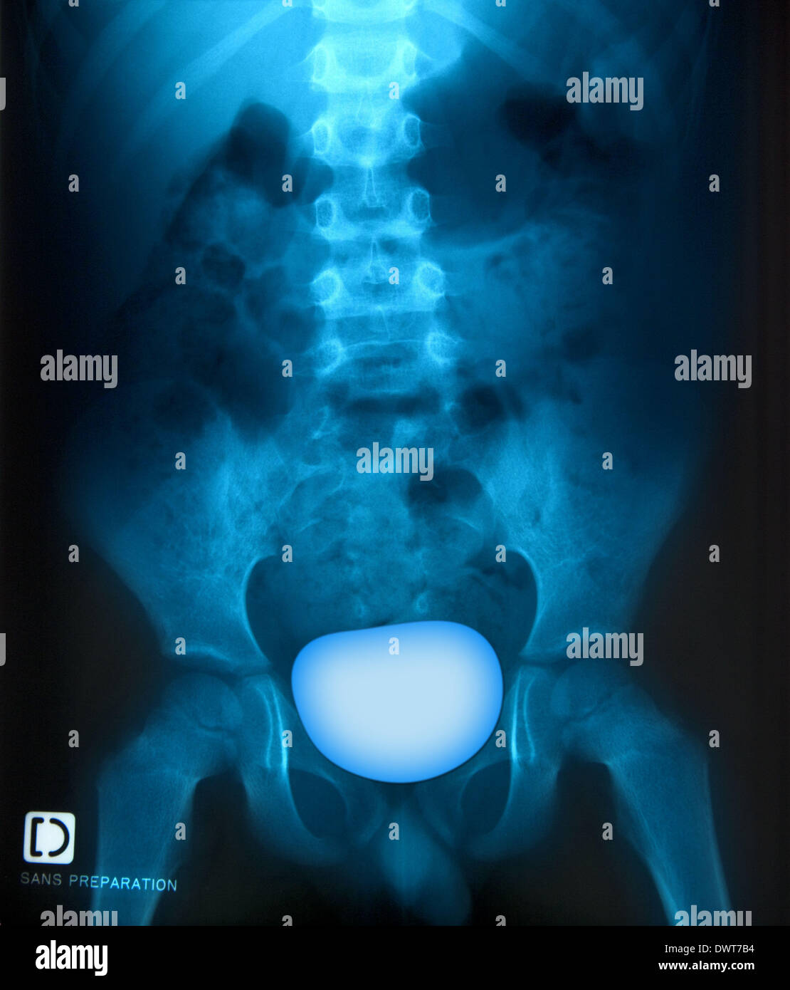 Cystography hi-res stock photography and images - Alamy