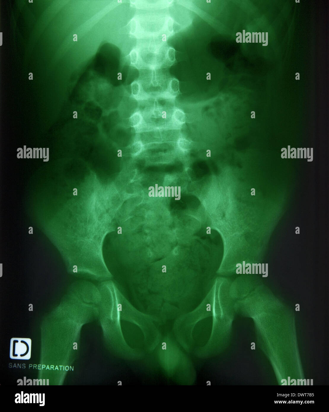 Child pelvis x ray hi-res stock photography and images - Alamy