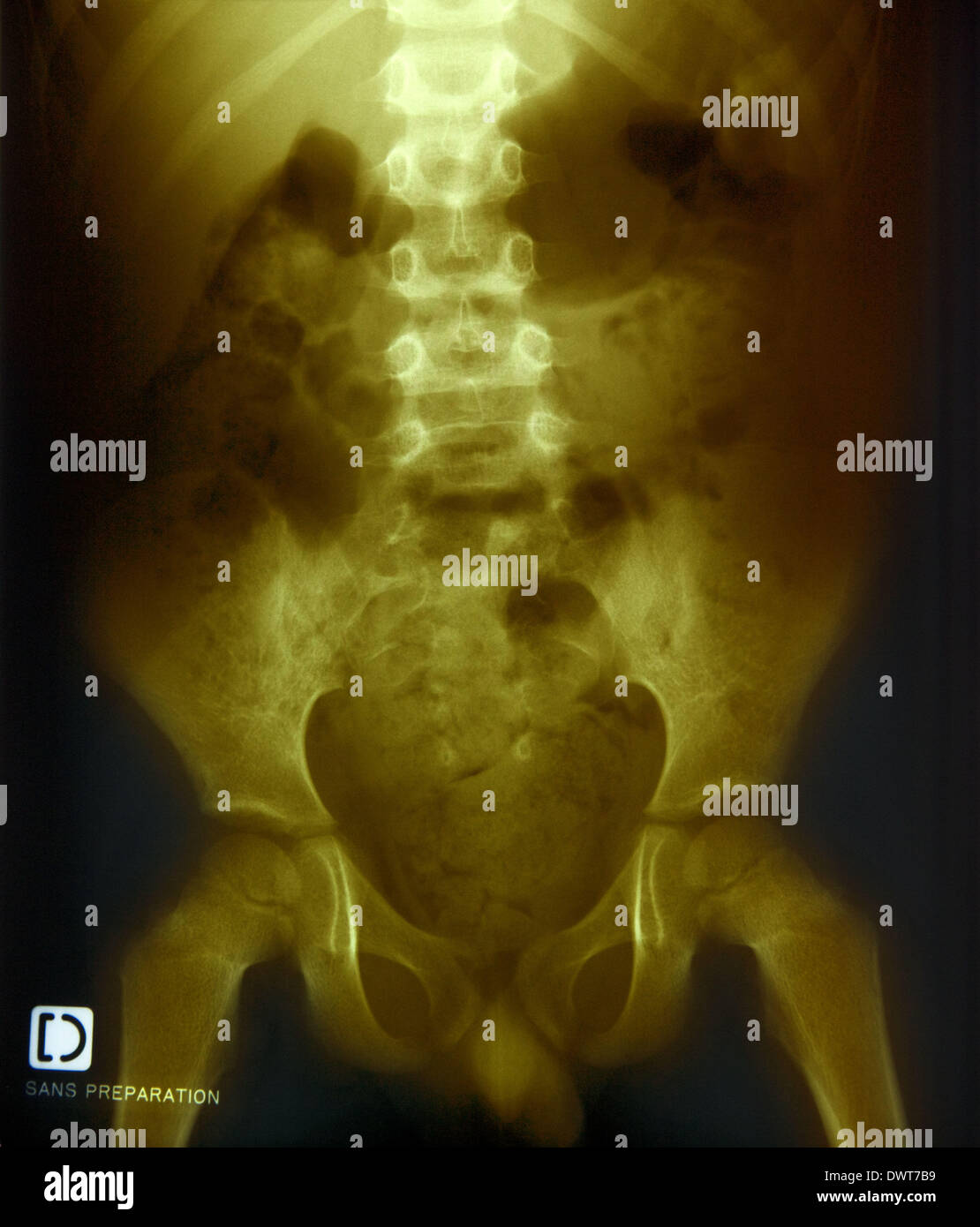 Cystography High Resolution Stock Photography and Images - Alamy
