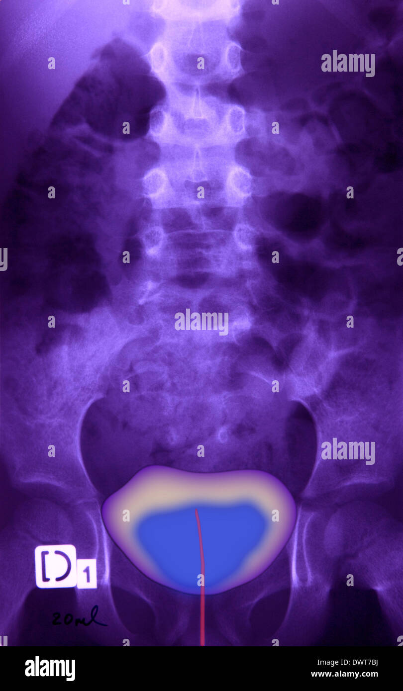Cystography hi-res stock photography and images - Alamy
