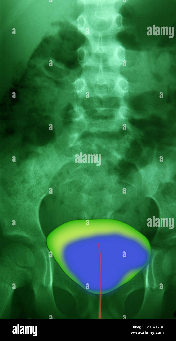 Cystography hi-res stock photography and images - Alamy