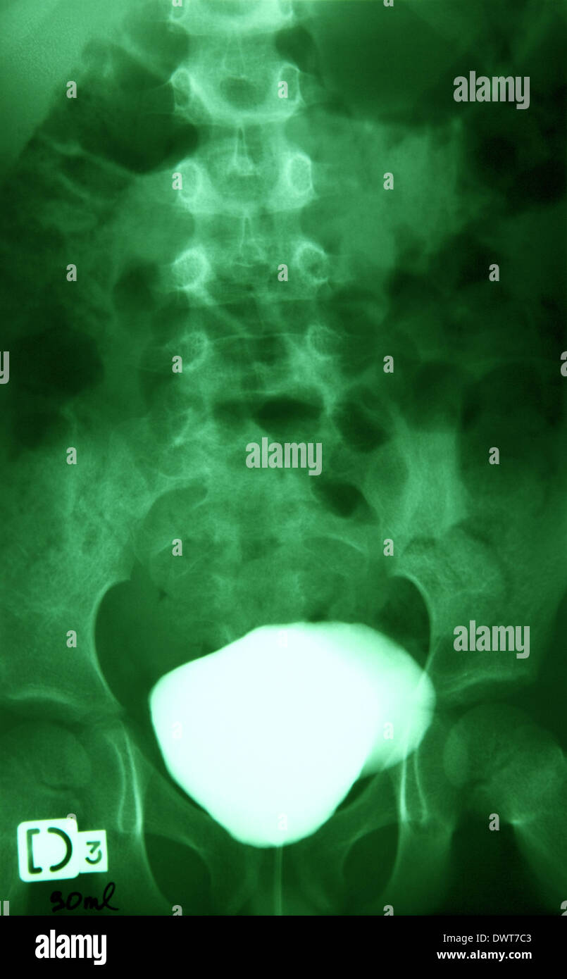 Child pelvis x ray hi-res stock photography and images - Alamy