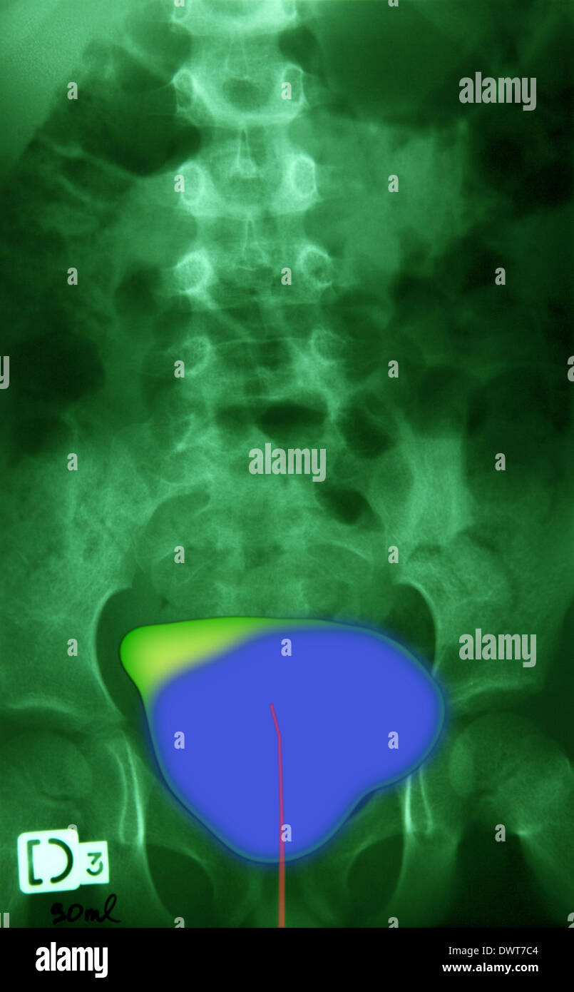 Cystography hi-res stock photography and images - Alamy