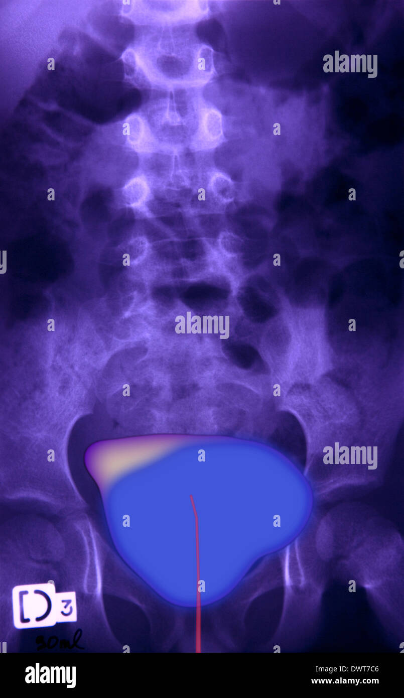 Cystography hi-res stock photography and images - Alamy
