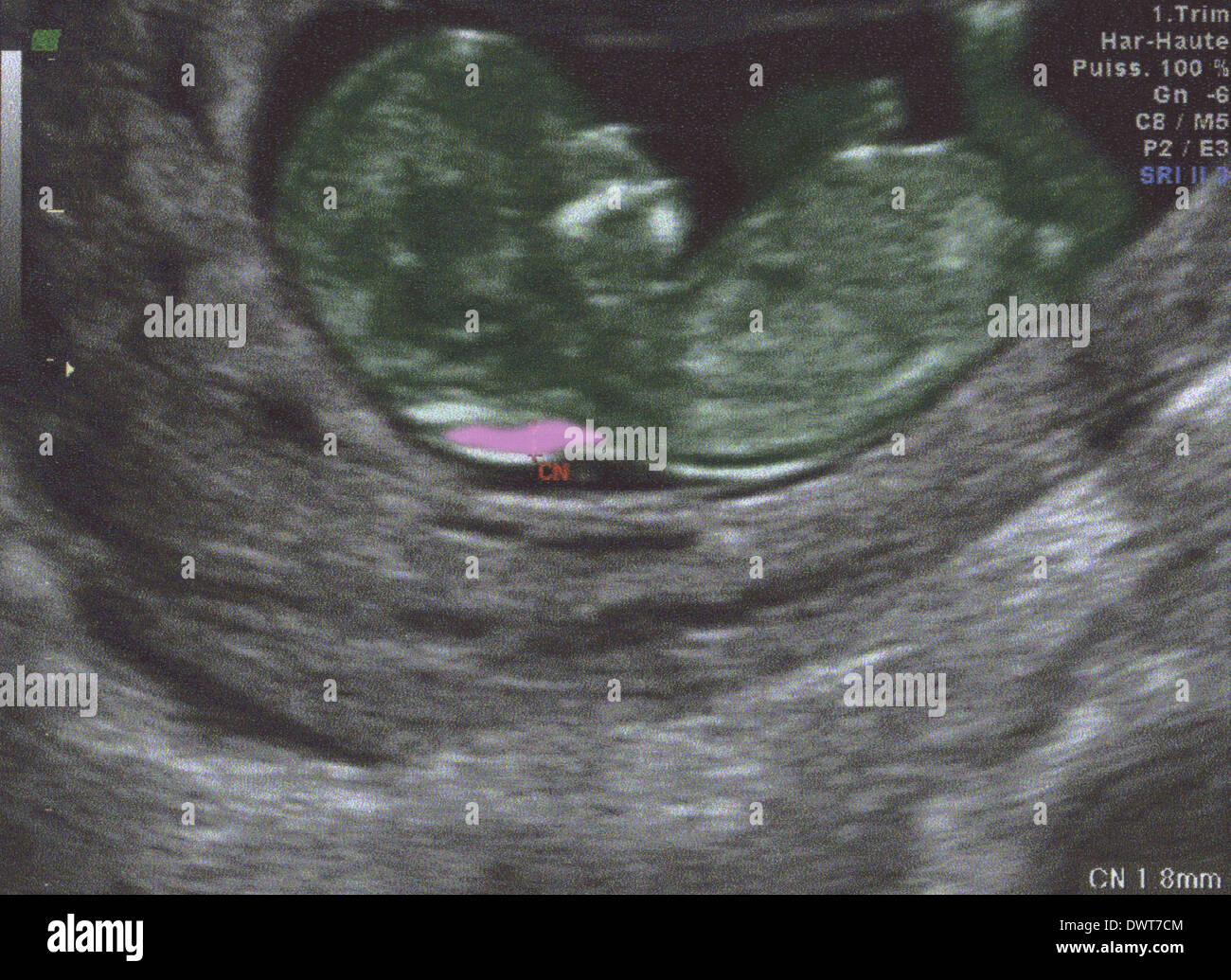 Fetus ultrasound scan Stock Photo - Alamy