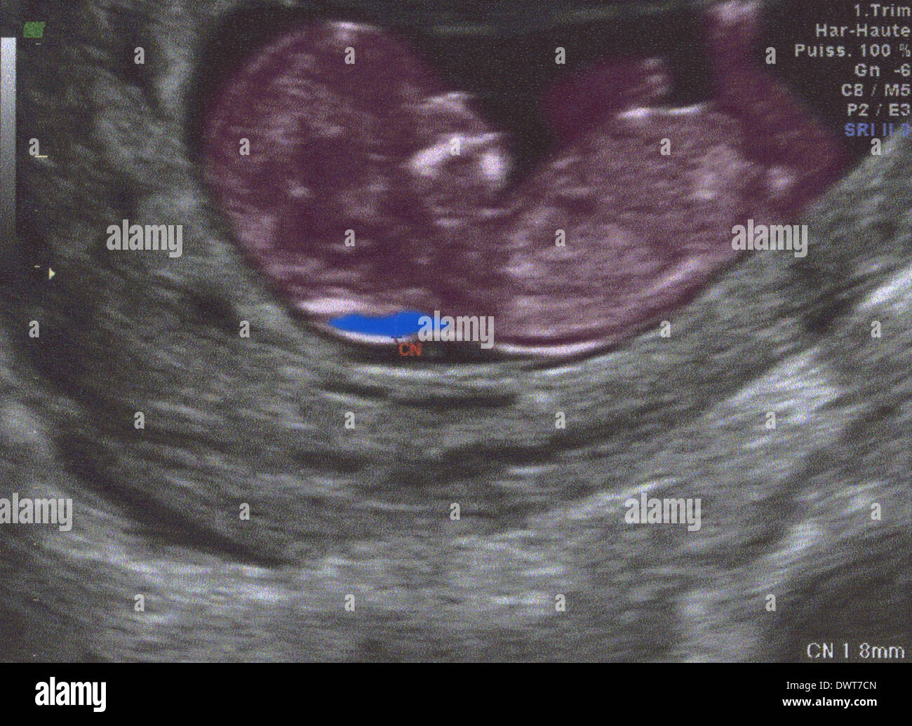 Fetus ultrasound scan Stock Photo - Alamy