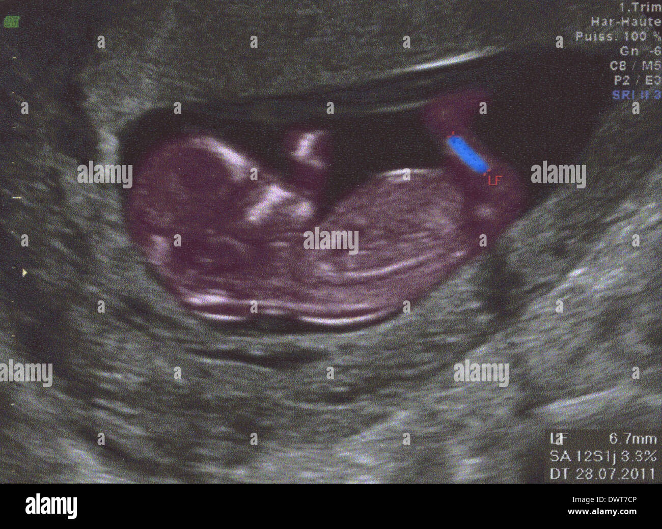 Ultrasound fetus first trimester hi-res stock photography and images ...
