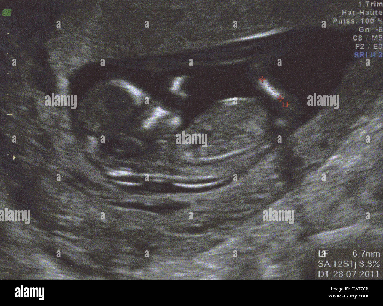 Fetus ultrasound scan Stock Photo - Alamy
