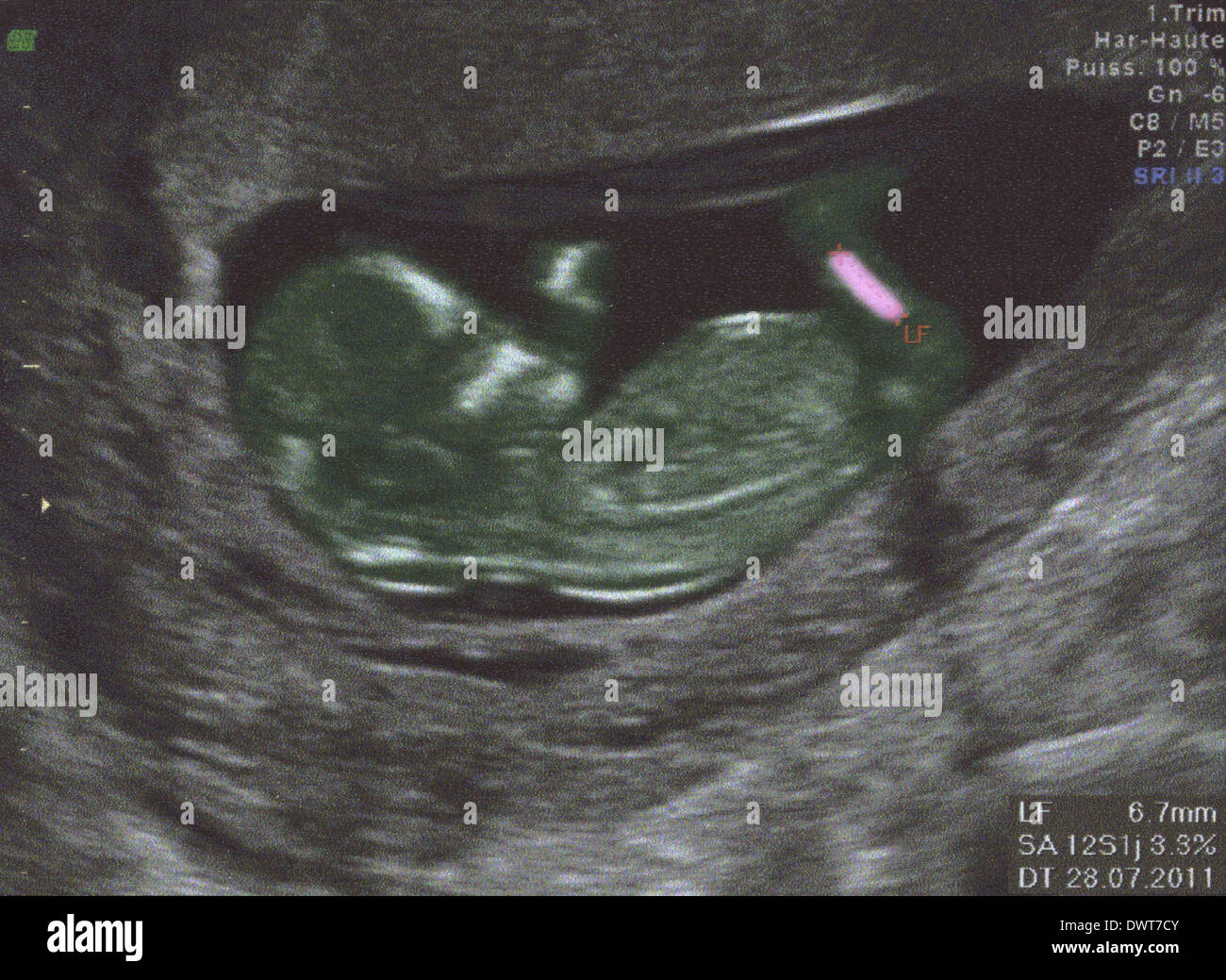 Fetus ultrasound scan Stock Photo - Alamy
