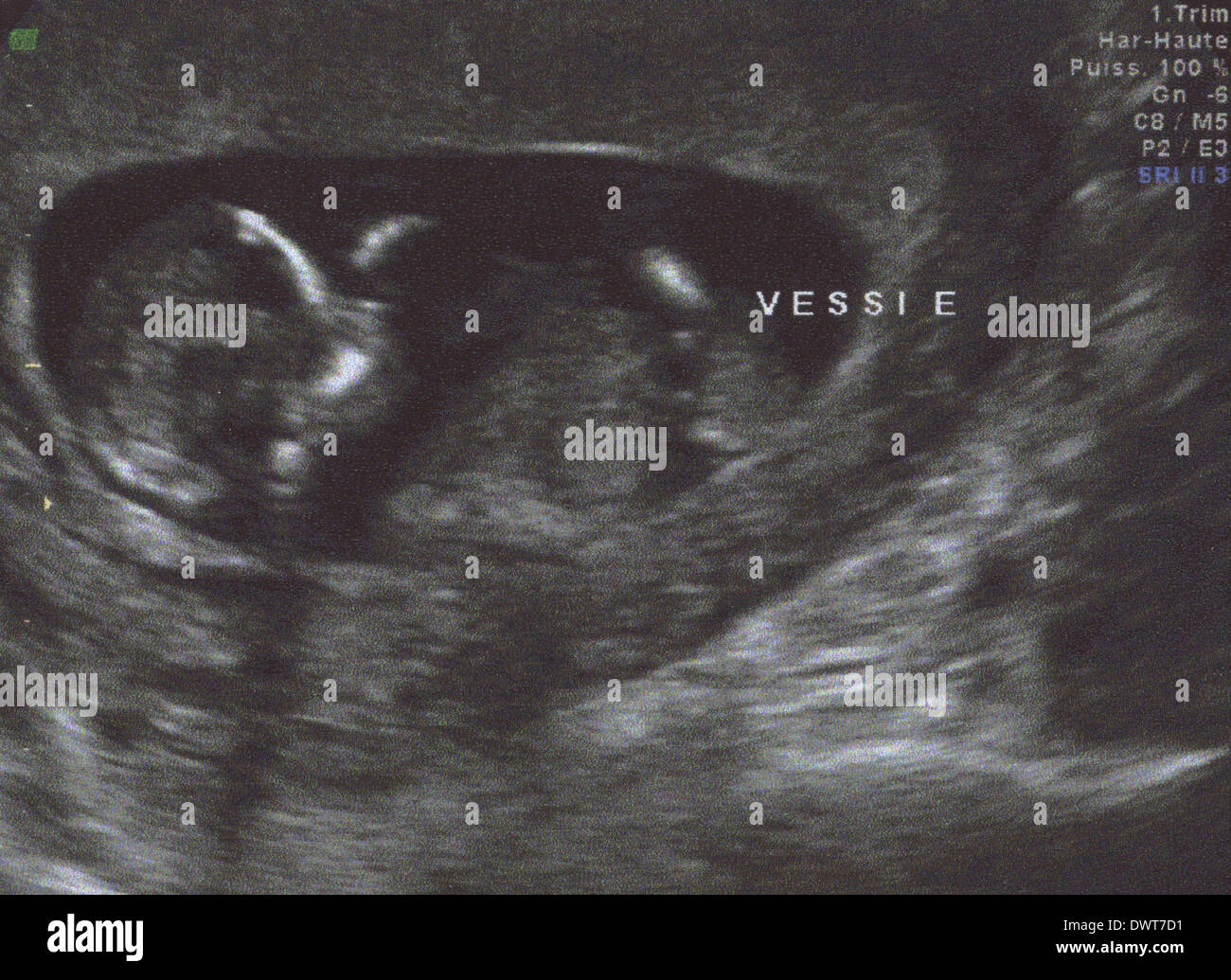 Fetus ultrasound scan Stock Photo - Alamy