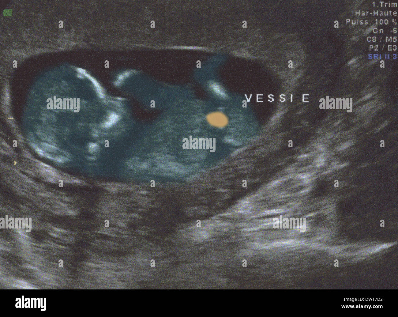 Fetus ultrasound scan Stock Photo - Alamy