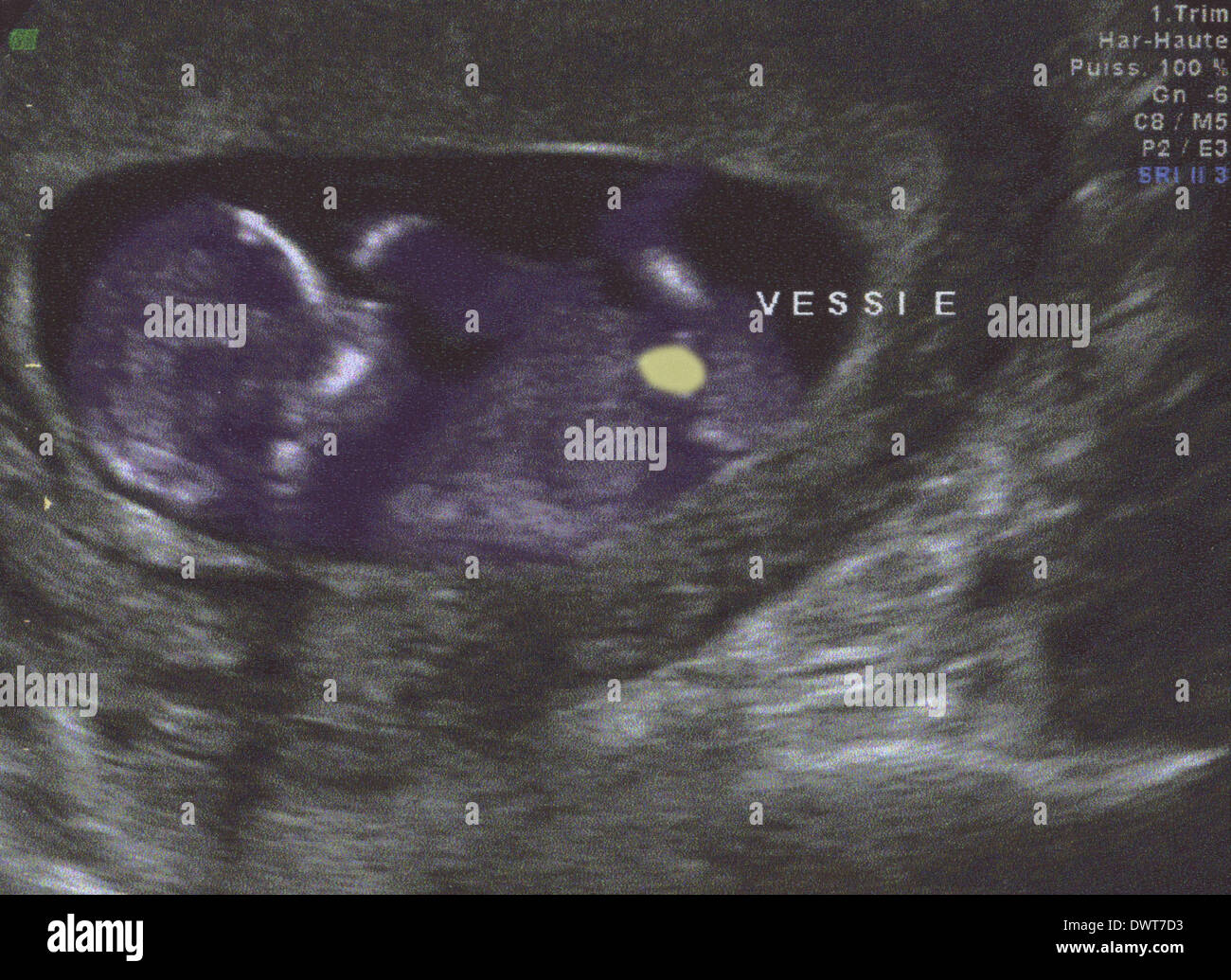 Fetus ultrasound scan Stock Photo - Alamy