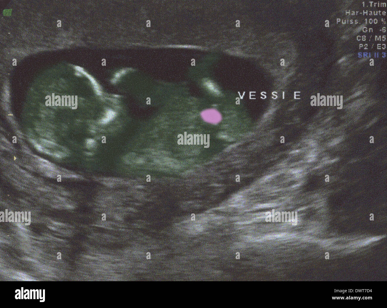 Fetus ultrasound scan Stock Photo - Alamy