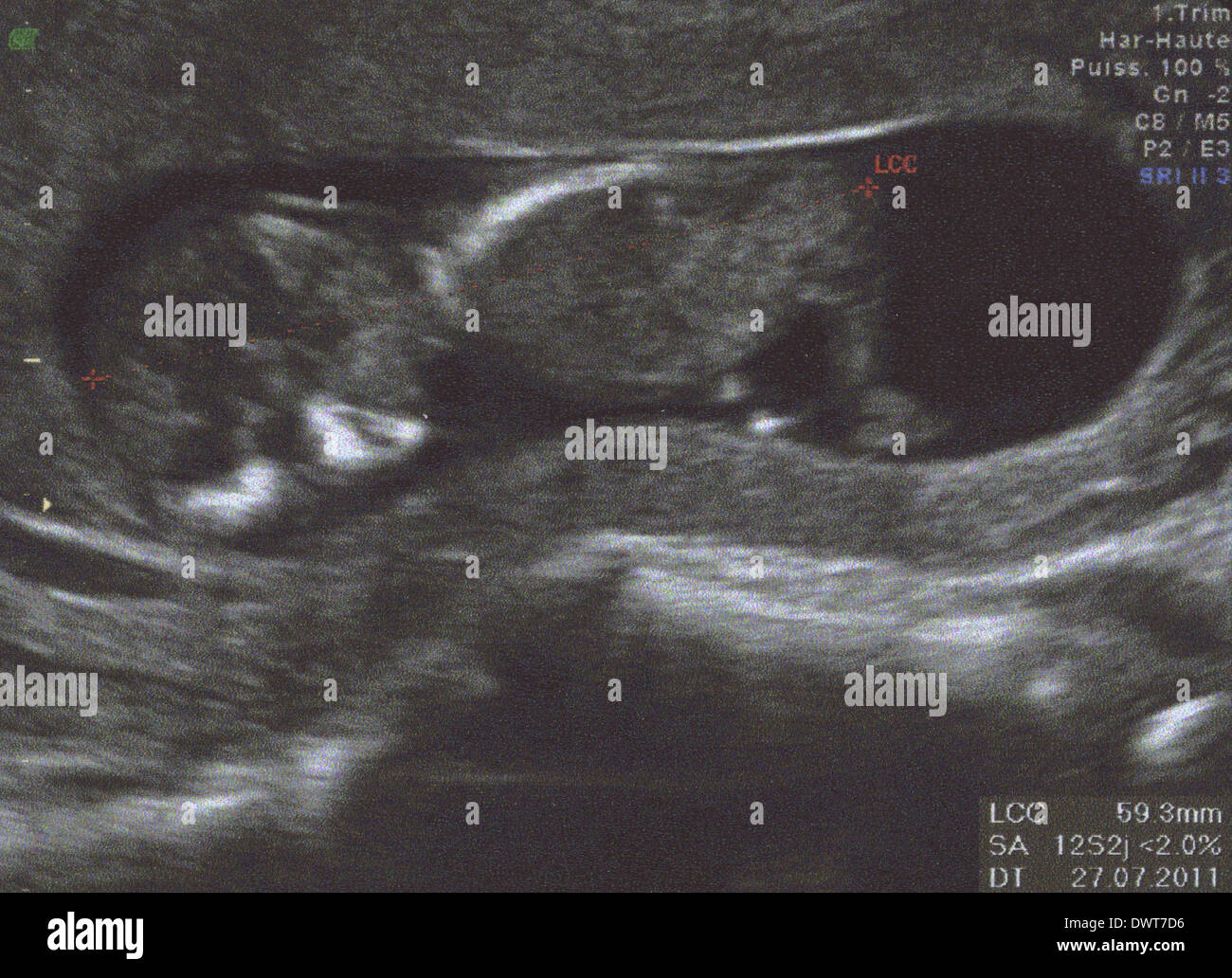 Fetus ultrasound scan Stock Photo - Alamy