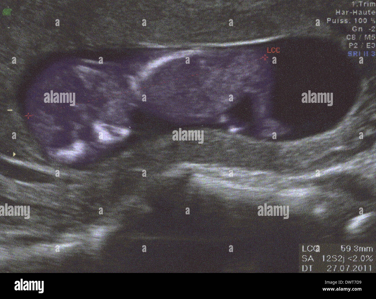 Obstetrical ultrasound scan hi-res stock photography and images - Alamy