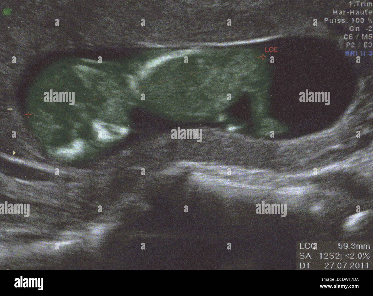 Fetus ultrasound scan Stock Photo - Alamy