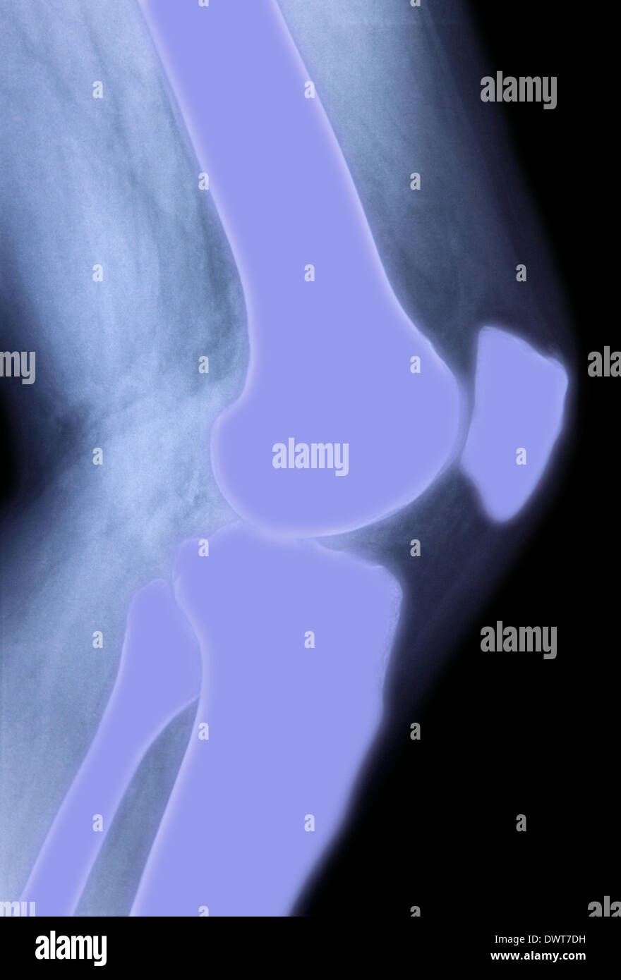 Knee x ray Stock Photo - Alamy