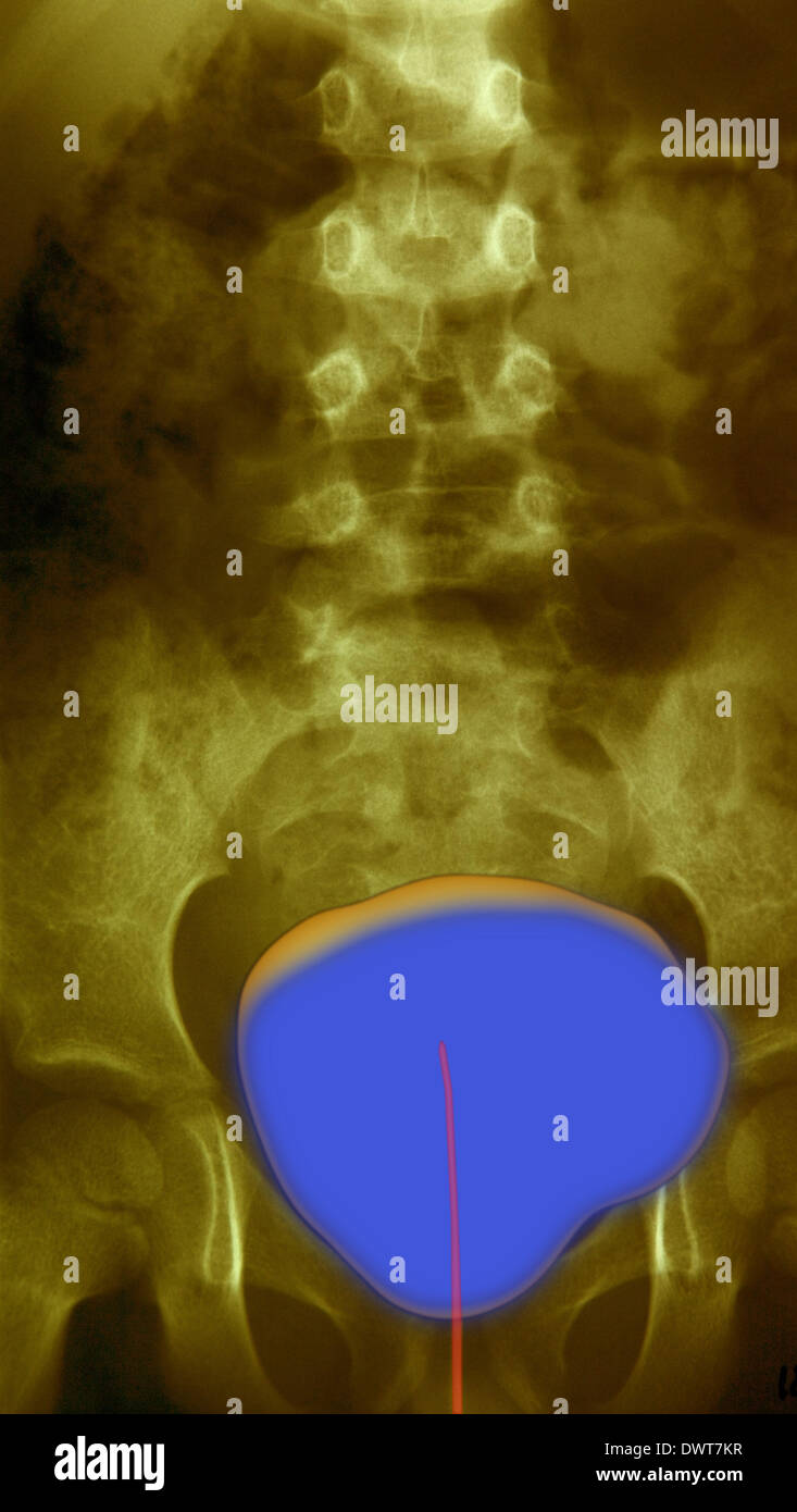 Cystography hi-res stock photography and images - Alamy