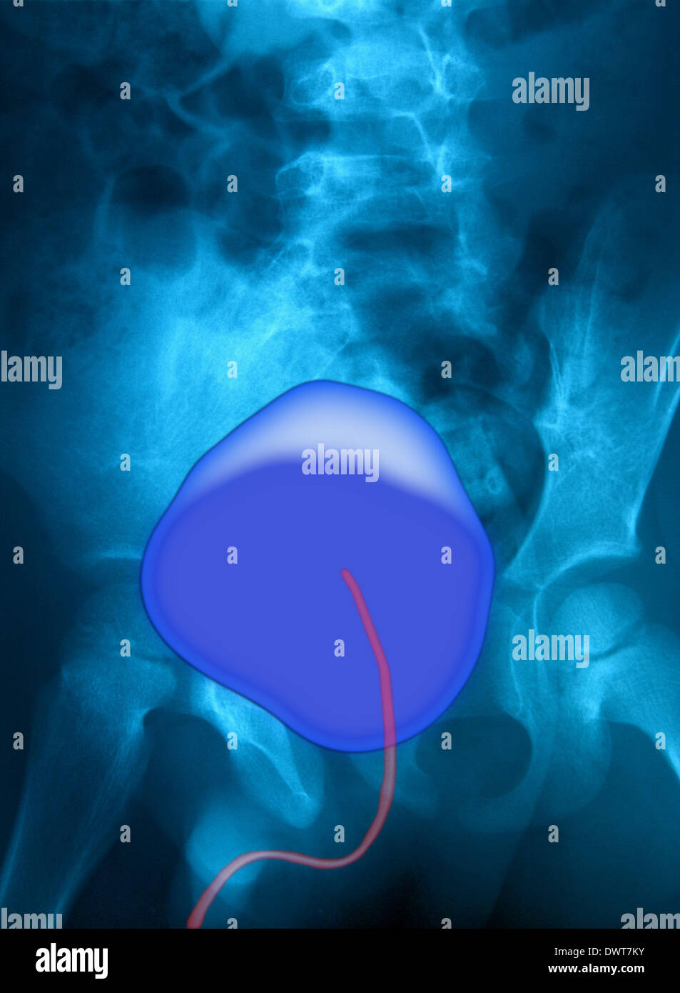 Cystography hi-res stock photography and images - Alamy