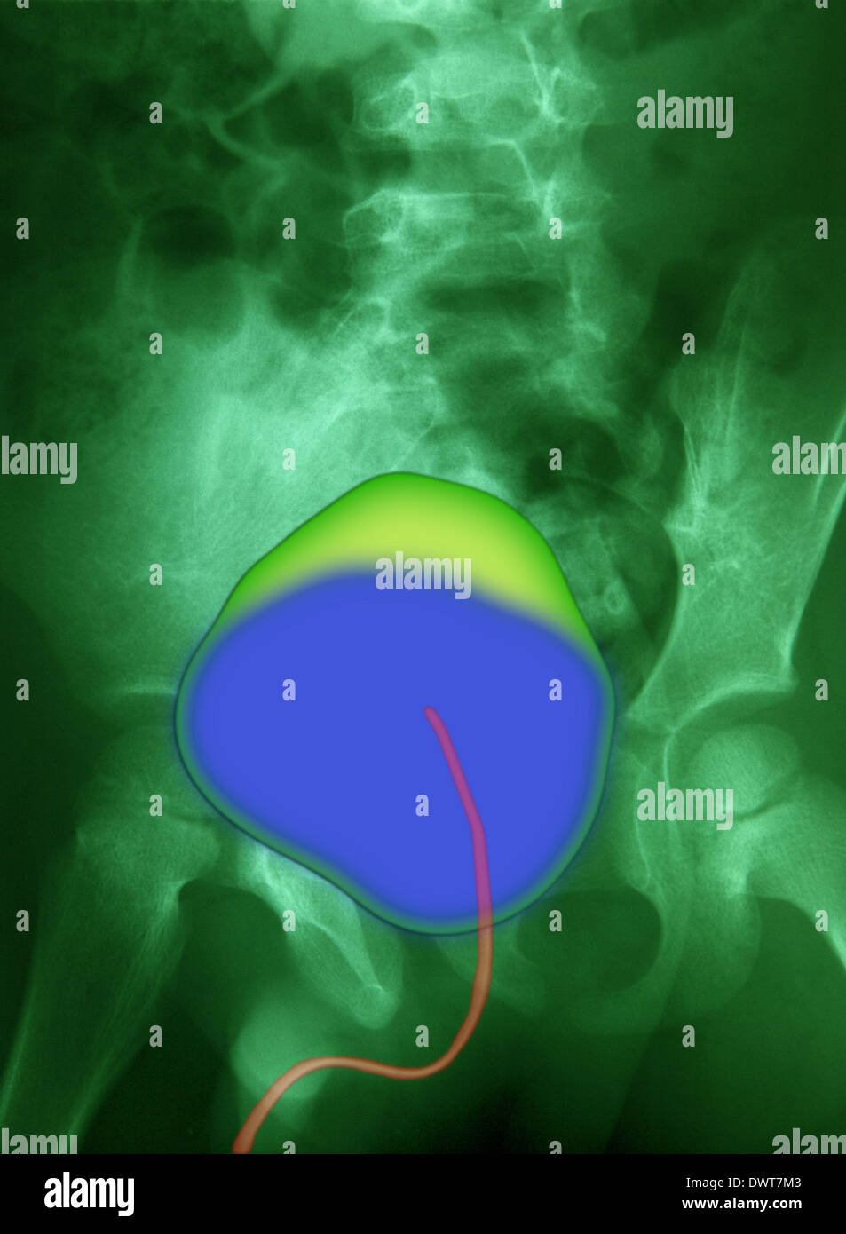 Cystography hi-res stock photography and images - Alamy