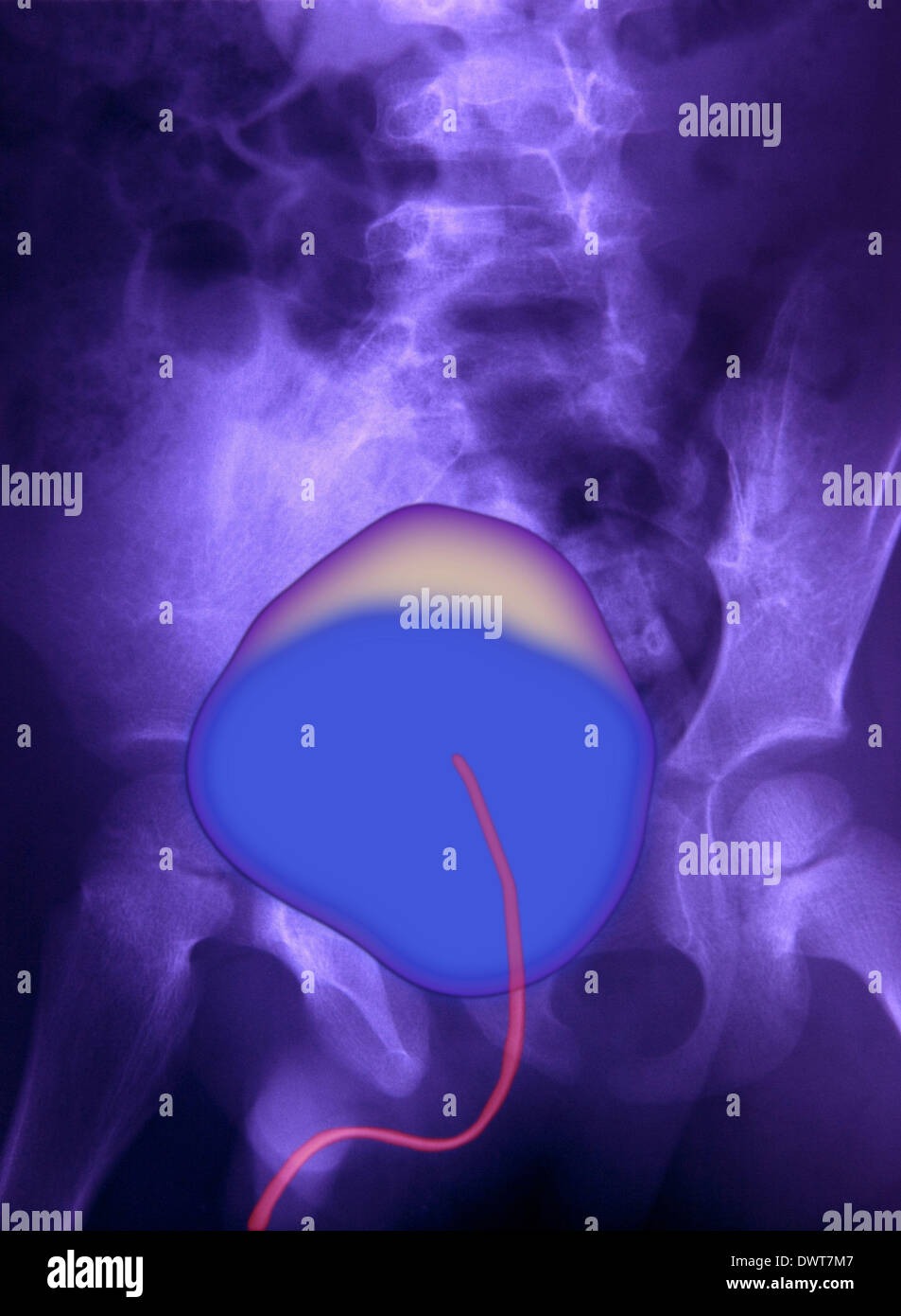 Cystography hi-res stock photography and images - Alamy