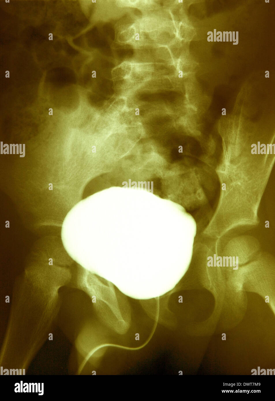 Cystography hi-res stock photography and images - Alamy
