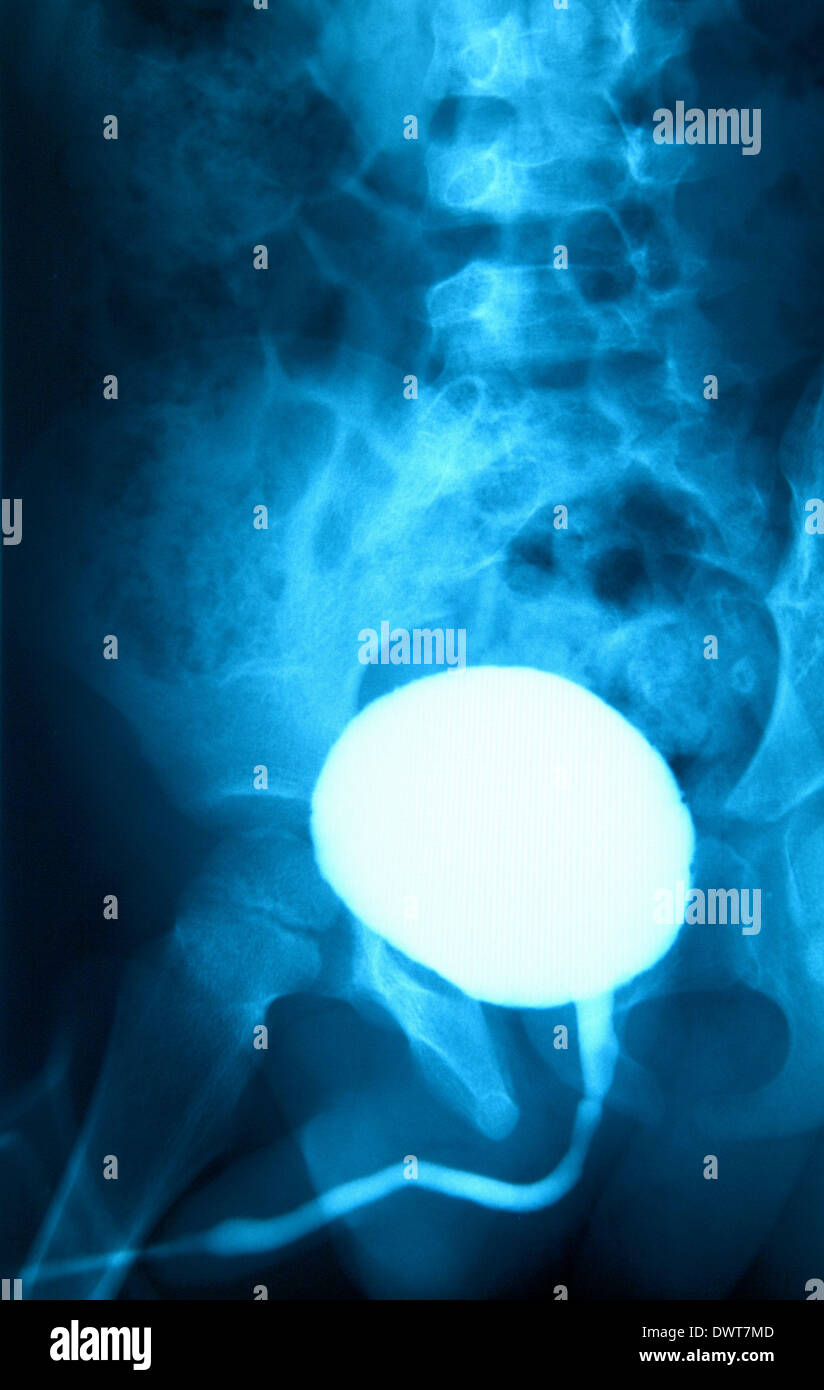 Cystography hi-res stock photography and images - Alamy