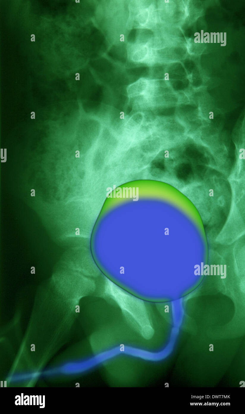 Cystography High Resolution Stock Photography and Images - Alamy