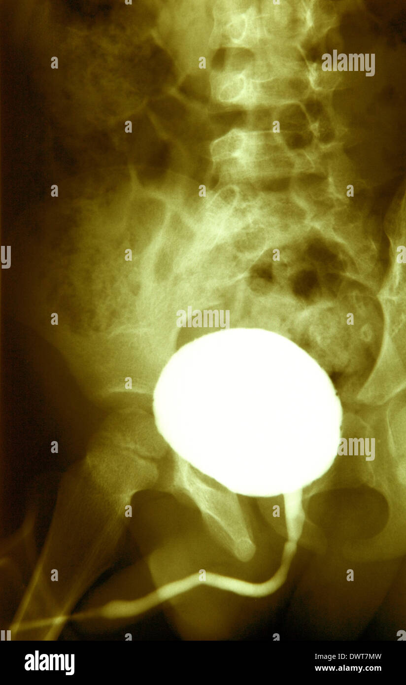 Cystography High Resolution Stock Photography and Images - Alamy