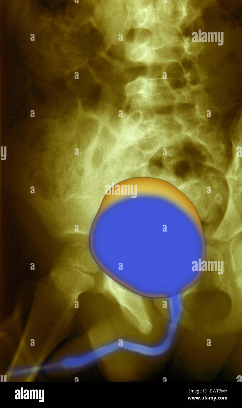 Cystography hi-res stock photography and images - Alamy