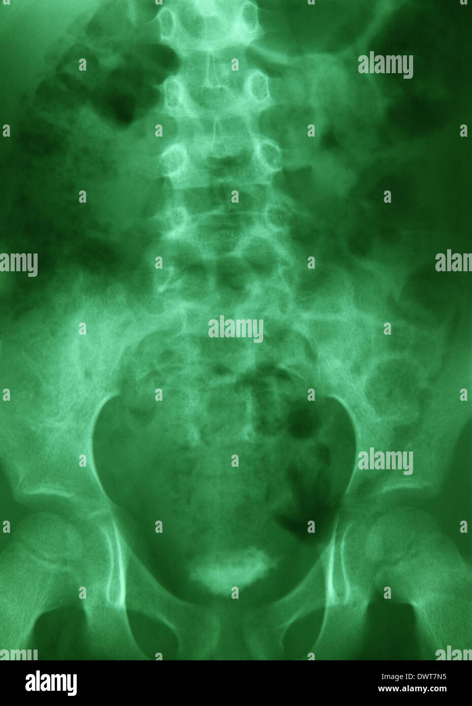 Cystography hi-res stock photography and images - Alamy