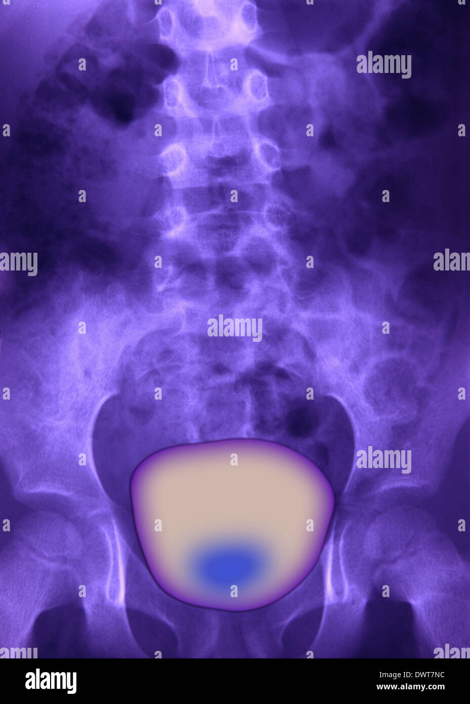 Child pelvis x ray hi-res stock photography and images - Alamy