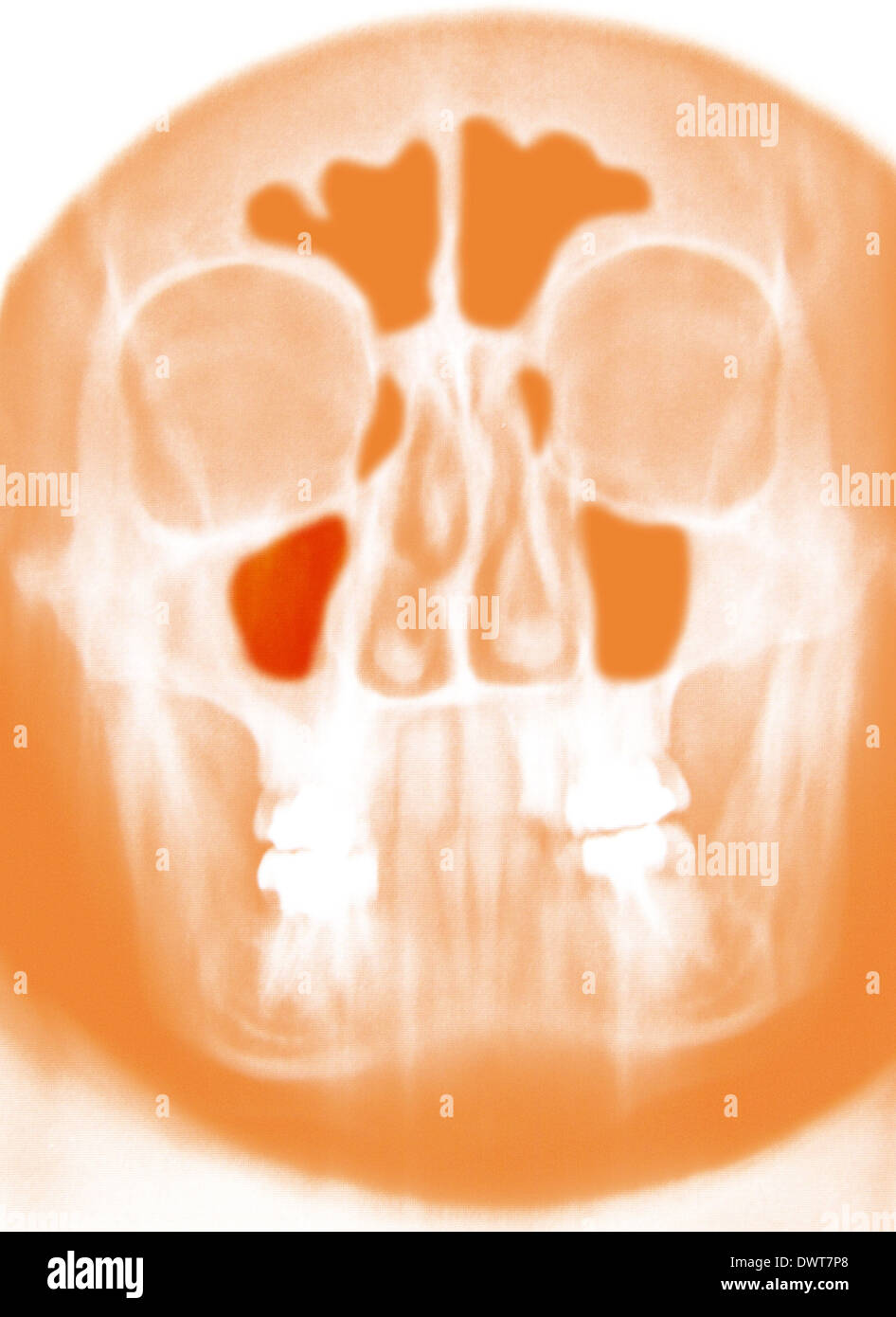 Maxillary paranasal hi-res stock photography and images - Alamy