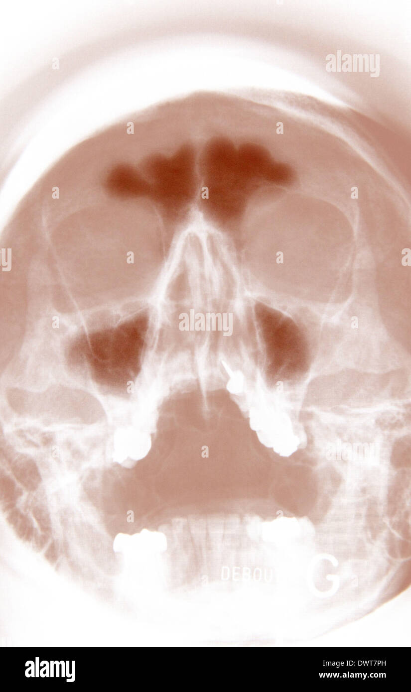 Sphenoid sinus hi-res stock photography and images - Alamy