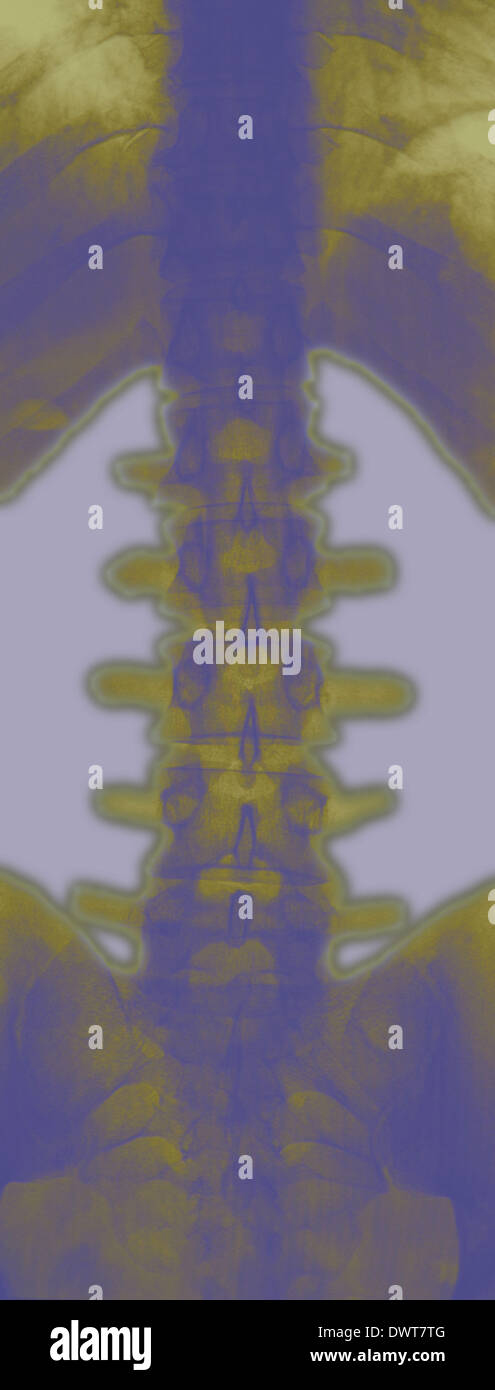 Vertebral column x ray Stock Photo - Alamy