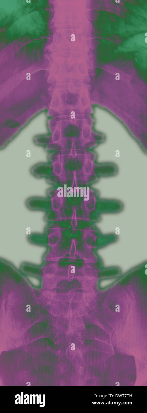 Vertebral column x ray Stock Photo - Alamy