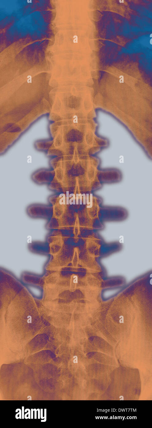 Vertebral column x ray Stock Photo - Alamy