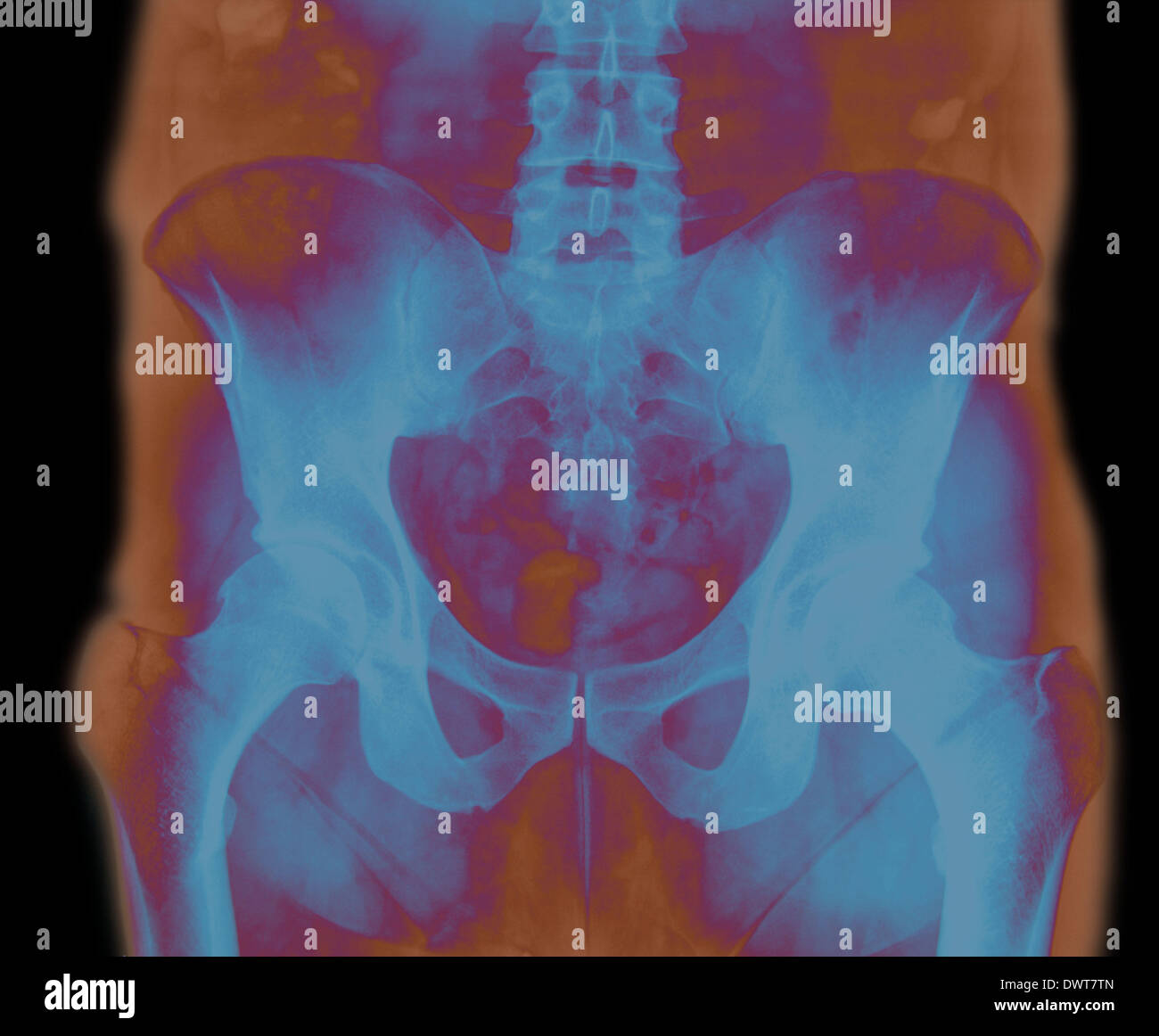 Pelvis x ray Stock Photo - Alamy