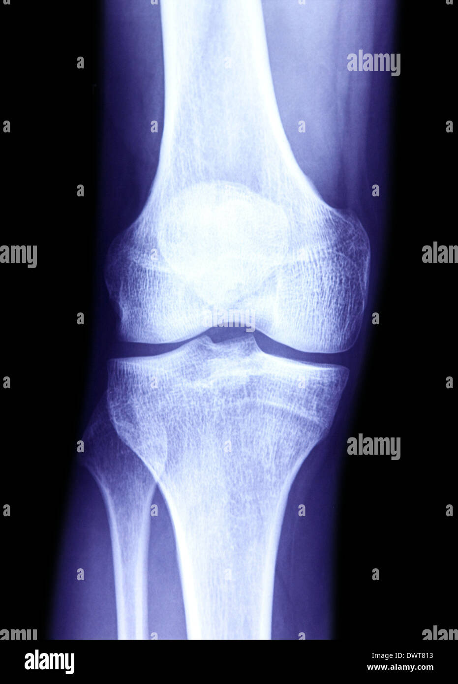 Knee x ray Stock Photo - Alamy