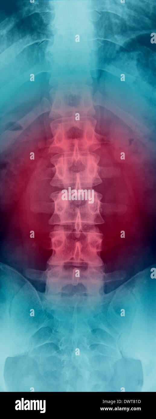 Vertebral column x ray Stock Photo - Alamy