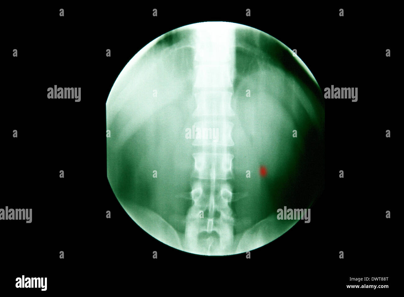 Kidney stone x ray Stock Photo - Alamy