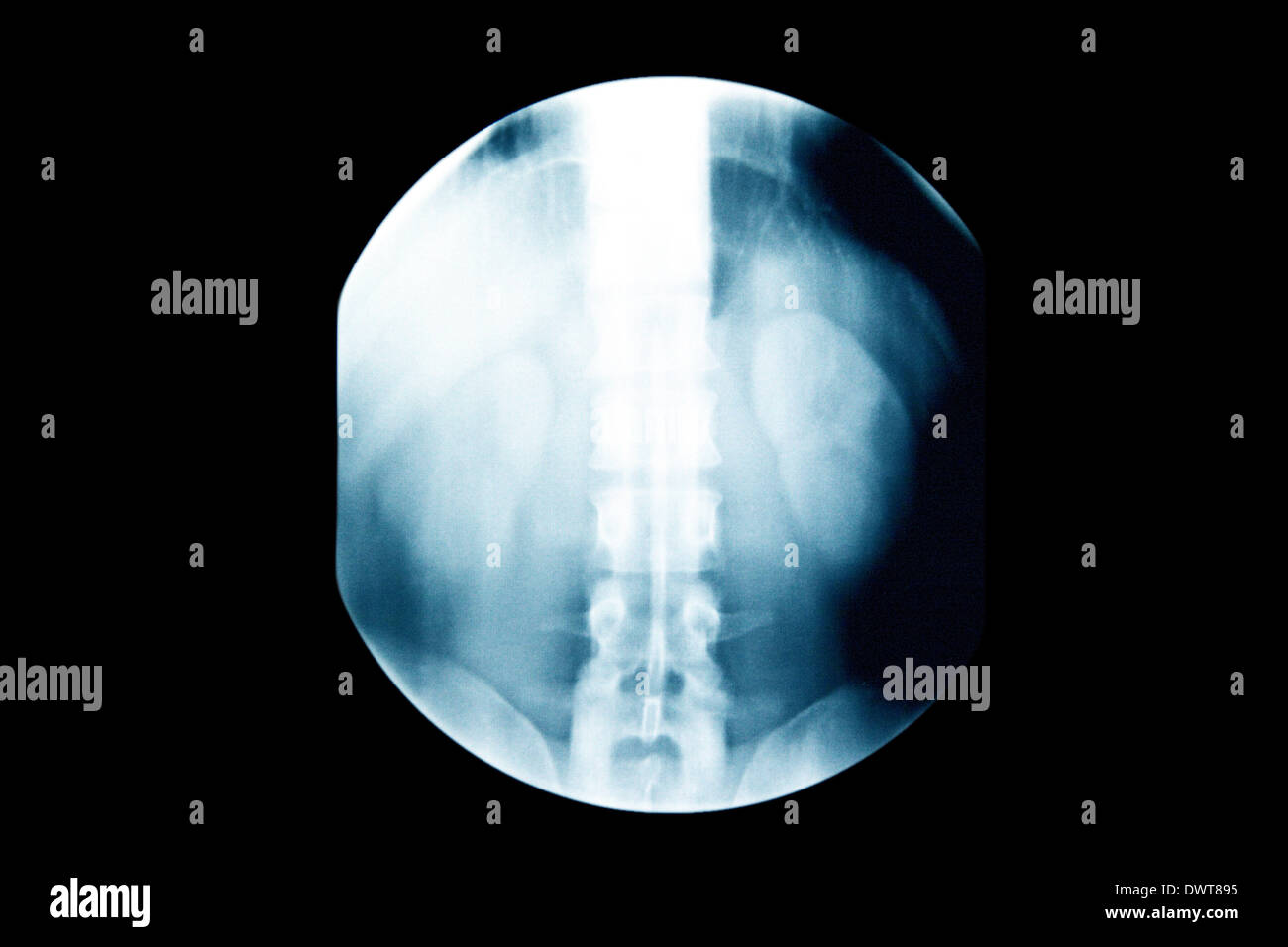Kidney x ray Stock Photo - Alamy