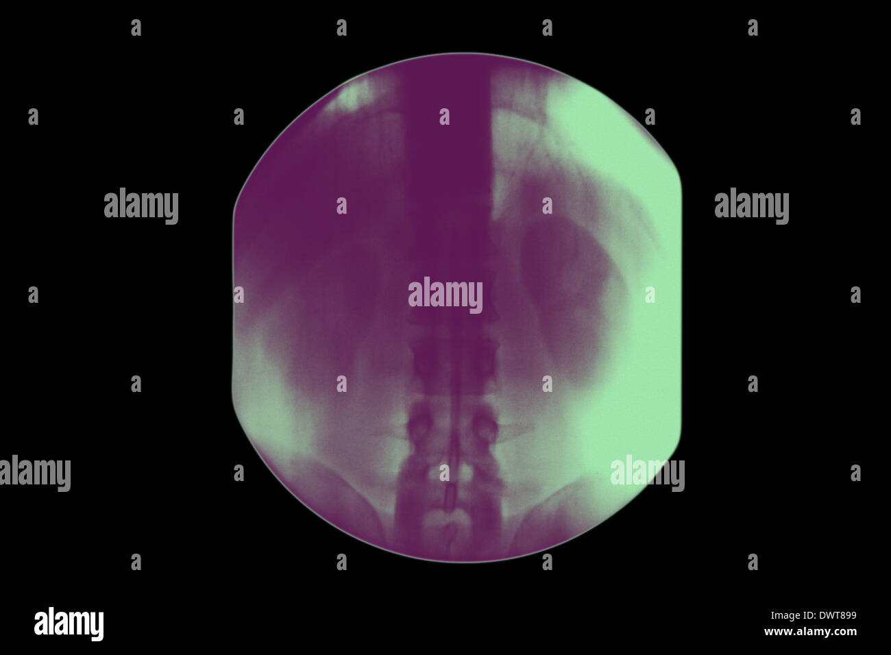Kidney x ray Stock Photo - Alamy