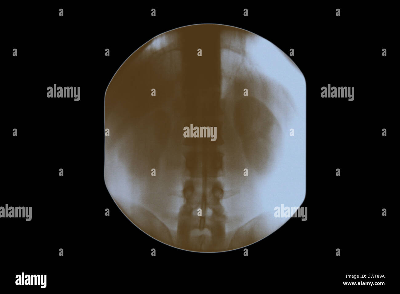 Kidney x ray Stock Photo - Alamy