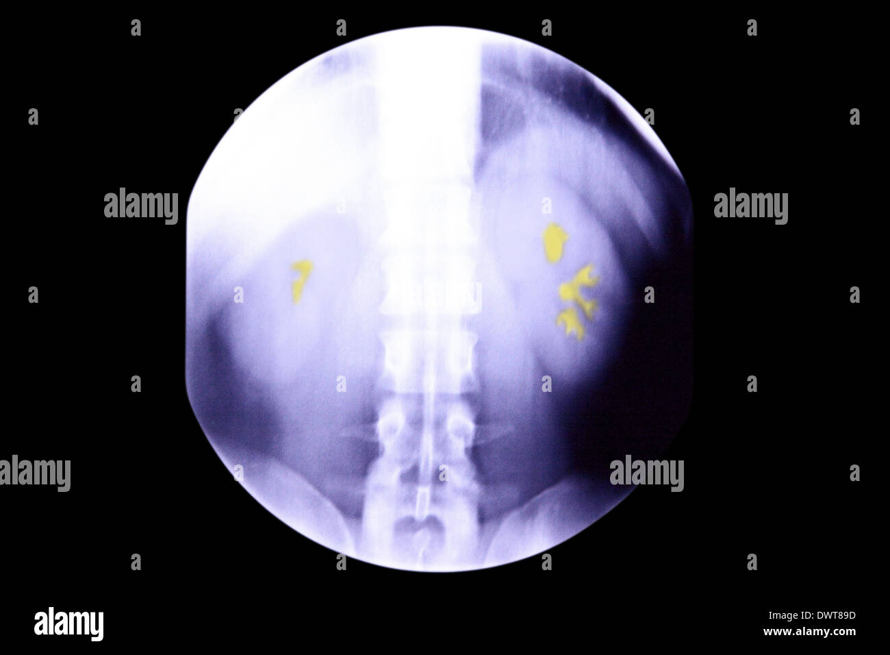 Kidney ultrasound scan Stock Photo - Alamy