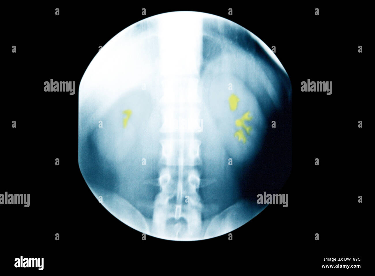 Ultrasound kidney hi-res stock photography and images - Alamy