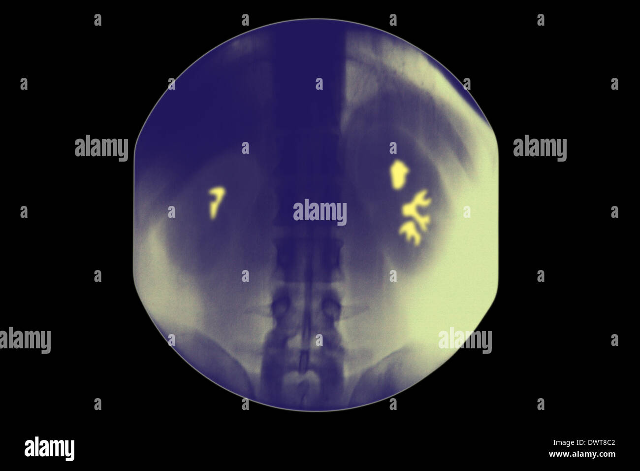 Kidney ultrasound scan Stock Photo - Alamy