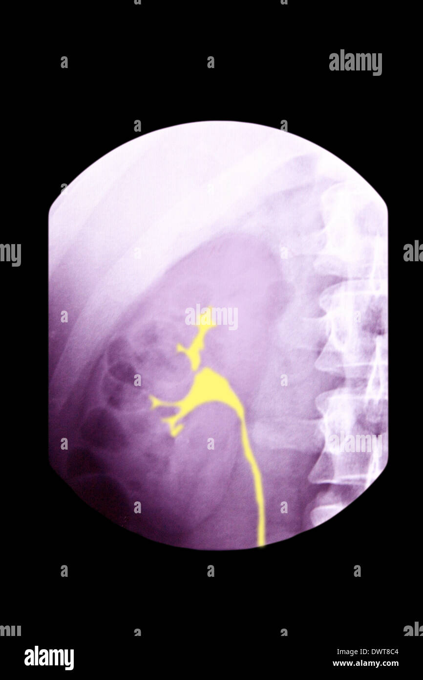 Kidney x ray Stock Photo - Alamy